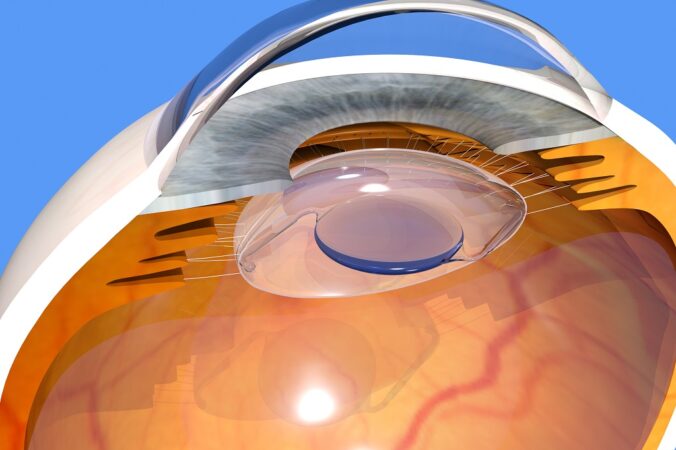 Is Refractive Lens Exchange Surgery Painful?
